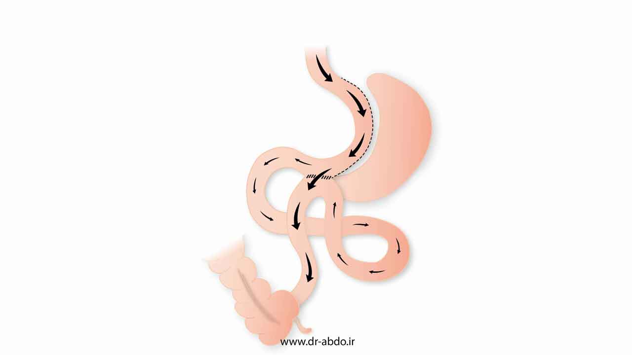 عمل ساسی بای پس چیست؟ |مراحل عمل ساسی بای پس معده dr-abdo