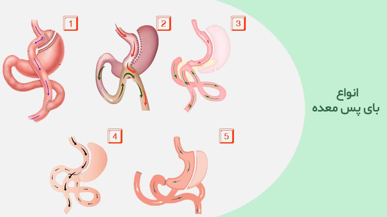 انواع بای پس معده ( بررسی 5 روش مناسب) - dr-abdo